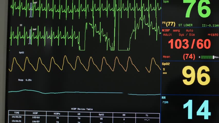 EKG Monitor In ICU Unit Show The Waves Of Blood Pressure, Blood Oxygen ...