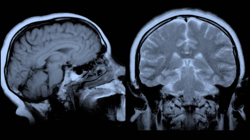 Magnetic Resonance Imaging. Human Brain. Animated Background. Stock ...